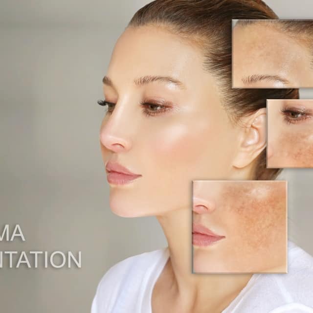 DARK SPOTS AND HYPERPIGMENTATION: THE CAUSES — Morganna's Alchemy Skin Care