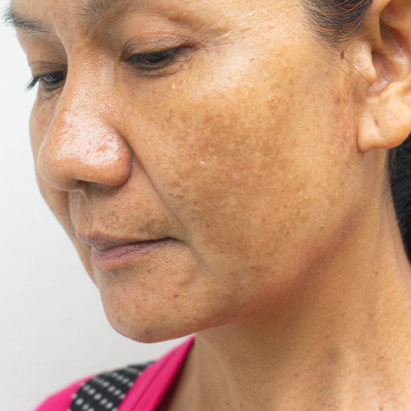 DARK SPOTS AND HYPERPIGMENTATION: THE CAUSES — Morganna's Alchemy Skin Care